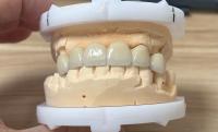 China Customized Cobalt-Chromium PFM Dental Restoration with Natural Appearance and Co-Cr Alloy Framework for PFM Crown and Bridge for sale