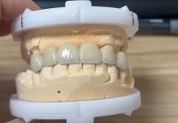 China Customized Cobalt-Chromium PFM Dental Restoration with Natural Appearance and Co-Cr Alloy Framework for PFM Crown and Bridge for sale