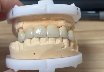 China Customized Cobalt-Chromium PFM Dental Restoration with Natural Appearance and Co-Cr Alloy Framework for PFM Crown and Bridge for sale