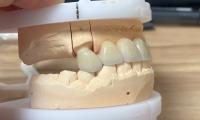 China Customized Cobalt-Chromium PFM Dental Restoration with Natural Appearance and Co-Cr Alloy Framework for PFM Crown and Bridge for sale