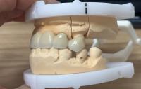 China Customized Cobalt-Chromium PFM Dental Restoration with Natural Appearance and Co-Cr Alloy Framework for PFM Crown and Bridge for sale