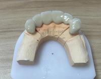 China Customized Cobalt-Chromium PFM Dental Restoration with Natural Appearance and Co-Cr Alloy Framework for PFM Crown and Bridge for sale