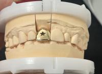 China Custom Gold Crown with Personalized Tooth Design and Customized Gold Appearance for Marginal Fit Inspection for sale