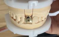 China Custom Gold Crown with Personalized Tooth Design and Customized Gold Appearance for Marginal Fit Inspection for sale