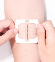 China Disposable Emergency wound Closure strips,Pu film strips Can Close The 3cm WoundZip Stitch Wound Closures Device for sale