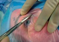 China Eye Ophthalmic Sterile Disposable Surgical Drapes Alcohol Resistant With Two Holes And Pouch for sale