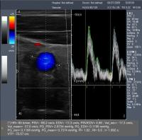 China 3D Laptop Ultrasound Scanner Color Doppler Machine With Large Volume Hardisk for sale