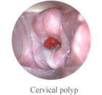 China Vaginal Videoscope Digital Video Colposcope Connected to Computer / TV with 3 Million Pixels to Take Photo for Cervix for sale
