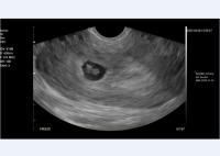 China Transvaginal Endocavity Ultrasound Scanner Wireless Probe For OB / GYN Mobile Device for sale