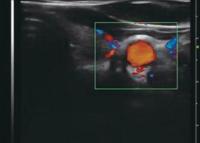 China Color Doppler Portable Pocket Ultrasound Scanner Application For MSK Breast Thyroid for sale