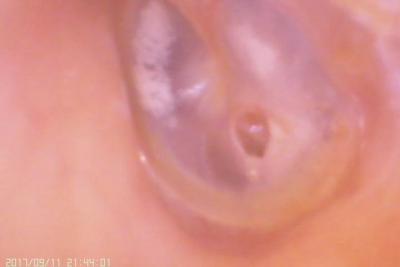 China Video Ear And Nose C amera Digital Otoscope For Perforation Of The Tympanic Membrane for sale