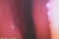 China Video Ear And Nose C amera Digital Otoscope For Perforation Of The Tympanic Membrane for sale