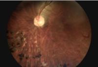 China Store Images And Videos Portable Fundus Camera for sale