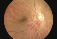 China Handheld Digital Fundus Camera With True 5MP Image Resolution And 45° FOV Support 2G to 32G Files Storge for sale