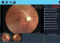 China Software of Report Available Digital Fundus Camera Telemedicine Ophthalmic Device With Rechargeable Lithium Battery for sale