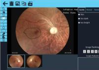China Ophthalmic Visualization Portable Non-Mydriatic Digital Fundus Camera Includes 7 Internal Fixation Points for sale