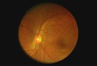China Ophthalmoscope Portable Handheld Fundus Camera Telemedicine Available Video Resolution 1280 X 960 Pixels for sale