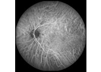 China Retina Angiograph Digital 160° Ophthalmic Equipment for sale
