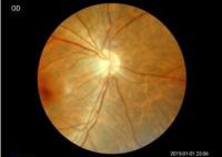 China Medical Ophthalmology Portable Fundus Camera Equipment for sale