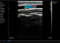 China 5MHz USB Palm Probe Connected Ipad Color Ultrasound for sale