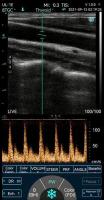 China Pocket Color Doppler Handheld Ultrasound Scanner Wifi USB Probe IPhone 10MHz Linear for sale
