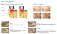 China 2023 Professional Picosecond Pico Laser Removal Laser Tattoo Removal Machine Laser for sale
