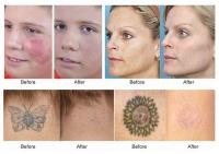 China Picosecond Laser ND YAG Pico Pigmentation Laser High Quality for Tattoo Removal Q Switched Carbon Peeling Ink Removal Machine for sale