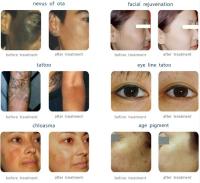China Picosecond Laser ND YAG Pico Pigmentation Laser High Quality for Tattoo Removal Q Switched Carbon Peeling Ink Removal Machine for sale