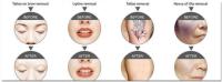 China Beauty Laser Treatment Equipment ND: YAG Laser Tattoo Removal Equipment for sale