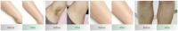China Machine Lebanon Diod Laser Hair Removal Diod Laser 808 Medical for sale