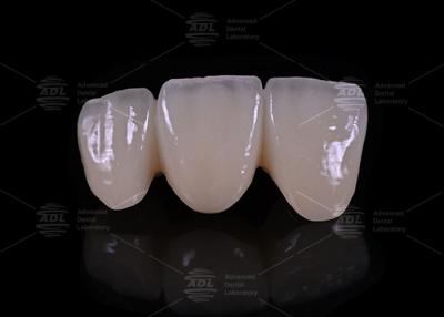 China China Dental Lab Accurate Precision Of Margins Layered Zirconia Hypoallergenic Biocompatible Dental Material For Durable And Restorations for sale
