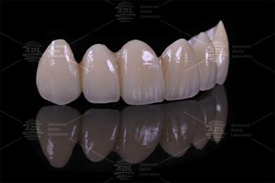 China Top 5 China dental lab providers Porcelain Fused To Zirconia ensuring turnaround time in 72 hours service for dental offices and labs for sale