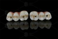 China Reinforcement Implant Bar CAD CAM Designed For Precision Fit Compatible With Most Dental Implant Systems Ensuring Dental Restoration Solutions Chinese Dental Lab for sale