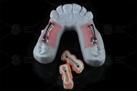 China Reinforcement Implant Bar CAD CAM Designed For Precision Fit Compatible With Most Dental Implant Systems Ensuring Dental Restoration Solutions Chinese Dental Lab for sale