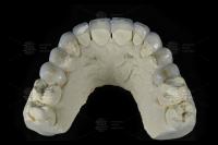 China 0.3mm-0.7mm Feldspathic EMAX Ceramic Veneers Natural Aesthetic Emax Dental Veneers for sale
