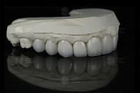 China 0.3mm-0.7mm Feldspathic EMAX Ceramic Veneers Natural Aesthetic Emax Dental Veneers for sale