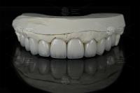 China 0.3mm-0.7mm Feldspathic EMAX Ceramic Veneers Natural Aesthetic Emax Dental Veneers for sale