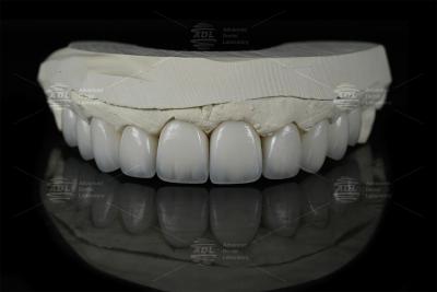 China 0.3mm-0.7mm Feldspathic EMAX Ceramic Veneers Natural Aesthetic Emax Dental Veneers for sale