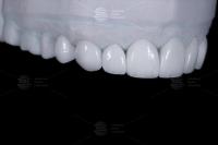 China China Dental Lab High Esthetics Translucency EMAX Veneer with 0.3-0.5mm Thickness for Anterior and Posterior Restorations for sale