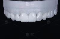 China China Dental Lab High Esthetics Translucency EMAX Veneer with 0.3-0.5mm Thickness for Anterior and Posterior Restorations for sale