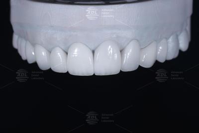 China China Dental Lab High Esthetics Translucency EMAX Veneer with 0.3-0.5mm Thickness for Anterior and Posterior Restorations for sale