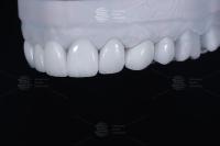 China China Dental Lab High Esthetics Translucency EMAX Veneer with 0.3-0.5mm Thickness for Anterior and Posterior Restorations for sale