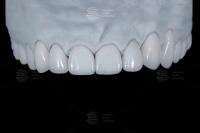 China Natural Tooth Color Ceramic Feldspathic Veneer For Anterior And Posterior Teeth for sale