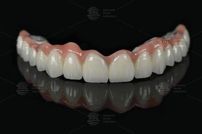 China Natural Looking PFM Implant  Bridge with Precise Fit and Co Cr Alloy Framework for Porcelain Fused To Metal Crown And Bridge Restorations for sale