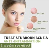 China Organic Herbal Anti Acne Remover Pimple Treatment Repair Scar Cream for sale