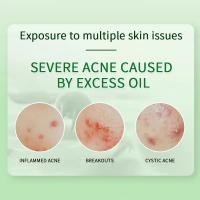 China Deep Cleaning Anti-Acne Repair Fade Acne Mark Acne Treatment Cream for sale