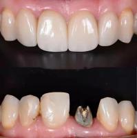 China Yucera  3D Pro Multilayer Multilayer Zirconia Block Cad /cam System  Ceramic Block 95mm System  for  Dental Lab for sale