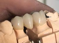 China Yucera 3D Pro Multilayer Open System Pre-shaded Dental Zirconia Blocks CADCAM Dental Ceramic Block for Lab for sale