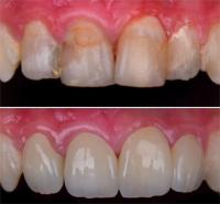China Yucera 4D-Multilayer 4D Pro Multilayer Zirconia Disc Disk Block CAD CAM Dental Laboratory Super Translucent 98mm for sale