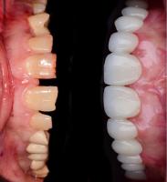 China 43%-57% Translucency 700-1200 MPa Bending Strength YUCERA Dental 98mm Open System CAD/CAM 4D Pro Multilayer Zirconia Block for sale